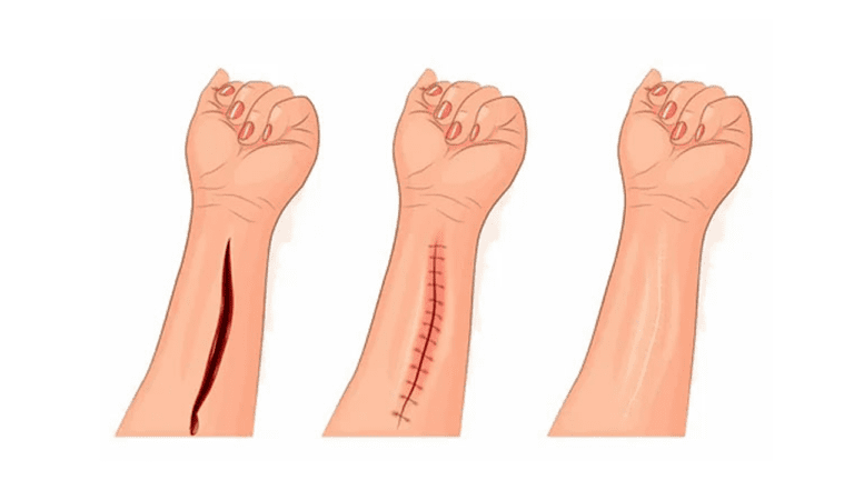 Skin Trauma & Chronic Wounds | Texas Advanced Surgical & Bariatrics